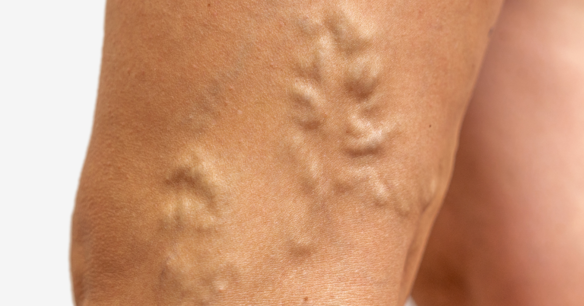 Varices. Complicaciones y Síntomas