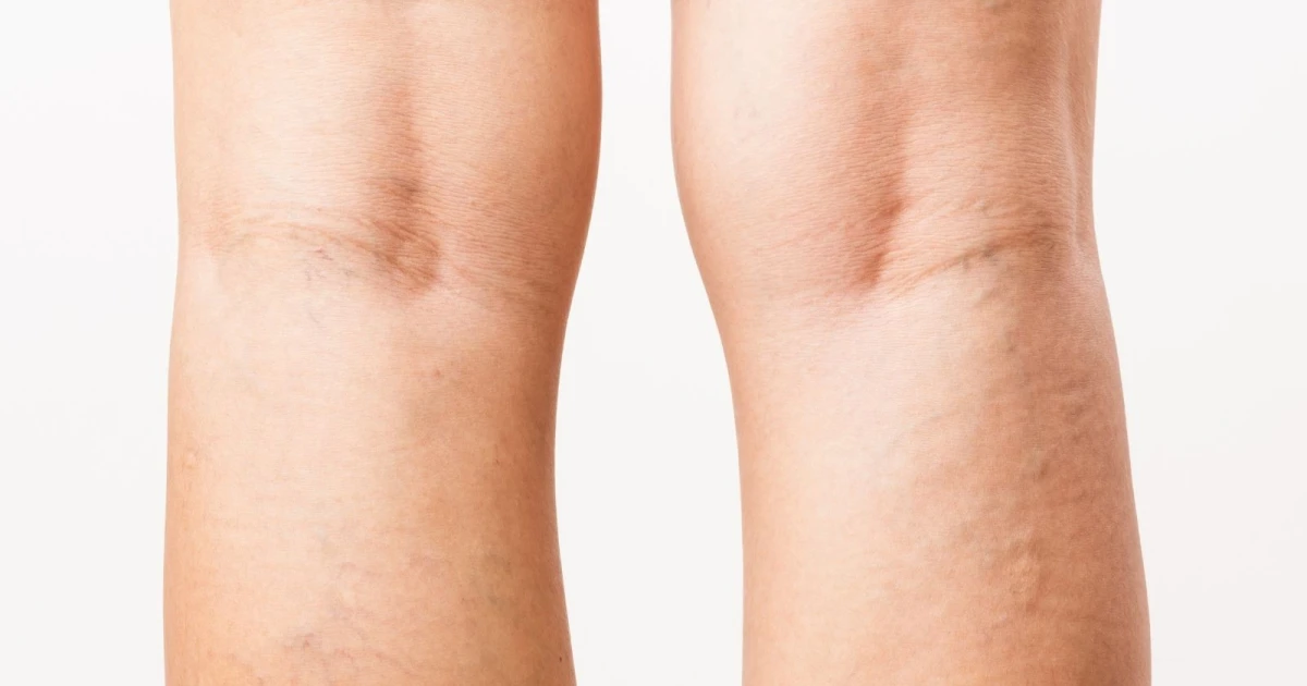 La operación de varices: ¿Qué hay que saber?