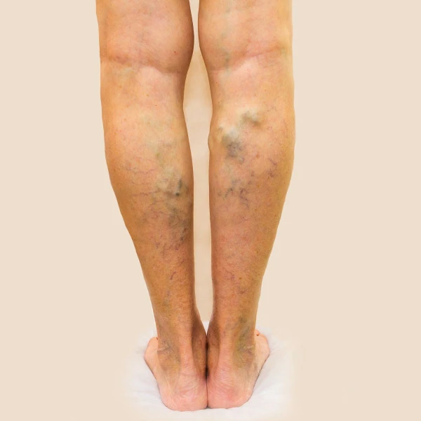 ️ 2.590€ Cirugía de varices por Radiofrecuencia | 1 pierna